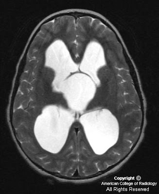 Neuroradiology On the Net: Suprasellar arachnoid cyst
