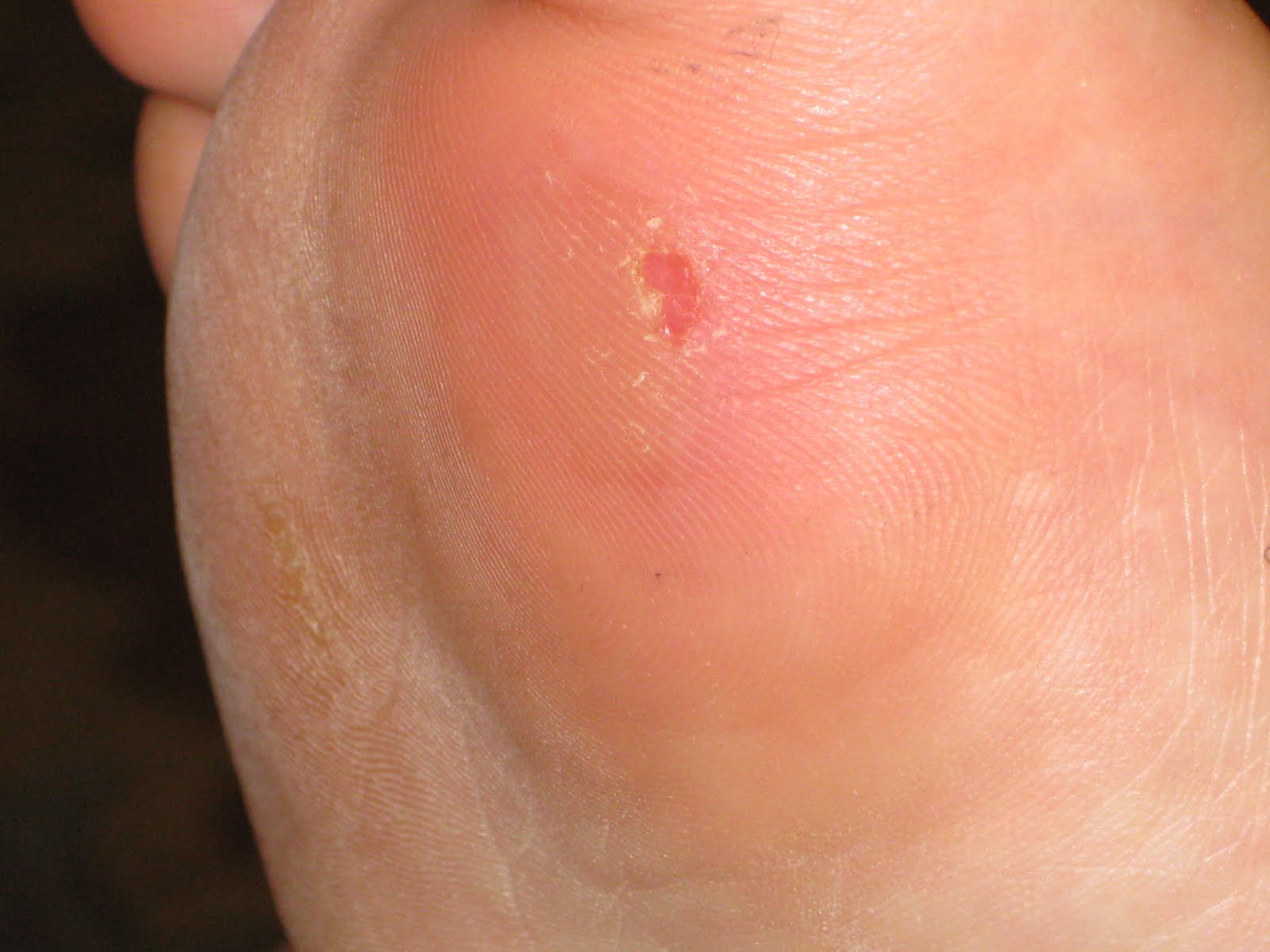 Sarah's Sarcasm: Abscess