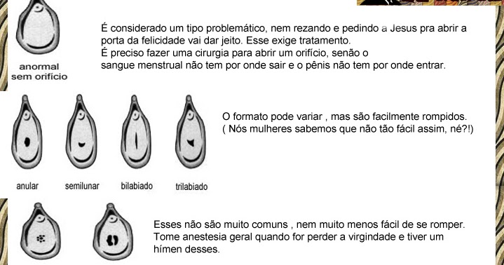 El Ninga: Tipos de hímens.