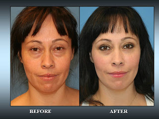 Orange county facelit: Fat Injection is the best filler for face