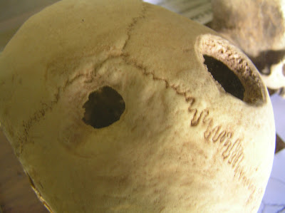 A lifetime of crazy, fun and unique adventures!: Inca head surgery