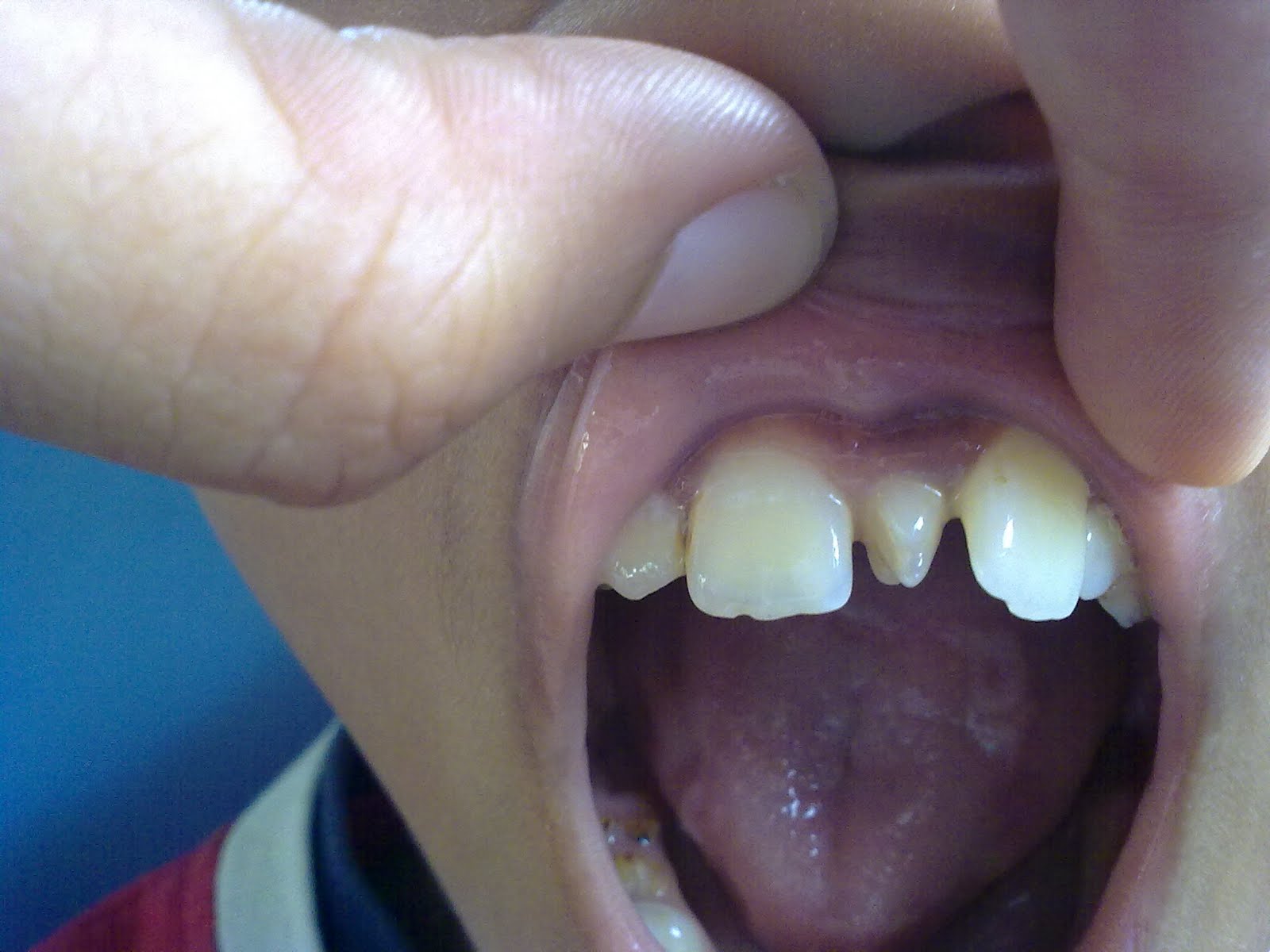 DRG. NURFAISAH: KELAINAN BENTUK DAN JUMLAH GIGI