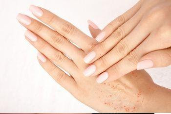 Herpetic Whitlow,Whitlow Finger: Whitlow finger