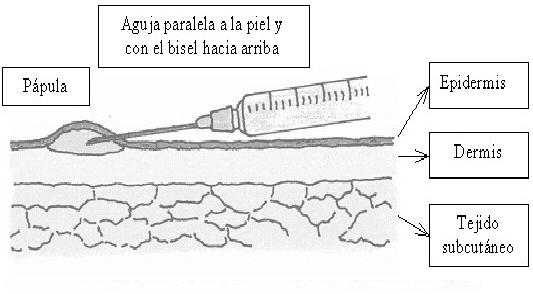 Nurse Things ┣ ═──────: PRÁCTICA. Inyección Intradérmica