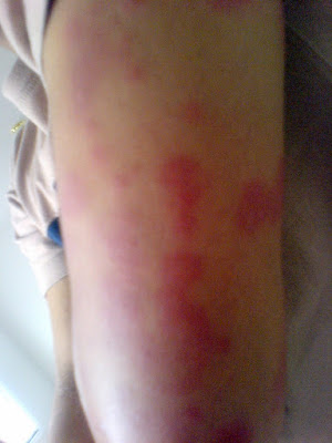 Floating Leaf: Khatmal - BedBugs - An unwelcomed guest