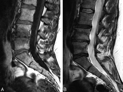 NEURORADIOLOGY: Classification of Modic endplate changes in ...