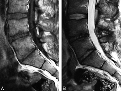 NEURORADIOLOGY: Classification of Modic endplate changes in ...