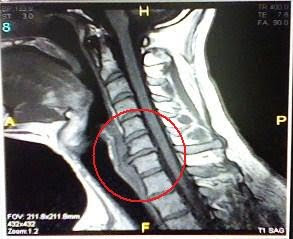 Aspergillus Niger: MRI of Cervical Neck