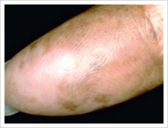 What is skin cancer?: What is Acral lentiginous melanoma