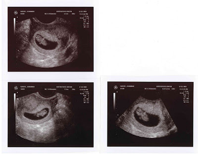 My Baby Blog: Ultrasound at 8 Weeks