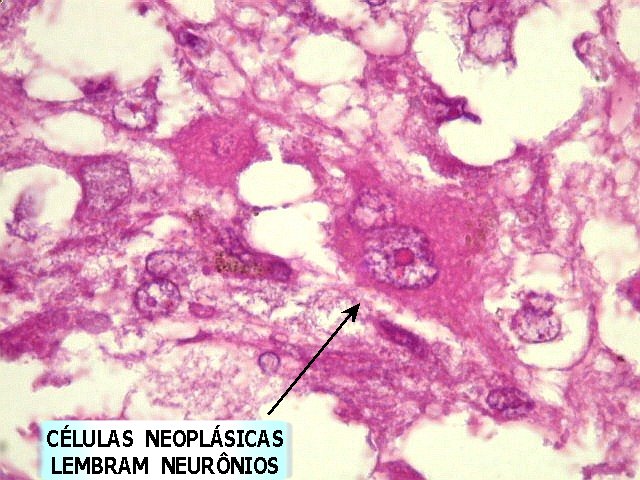 Historia do Feocromocitoma.: FEOCROMOCITOMA.