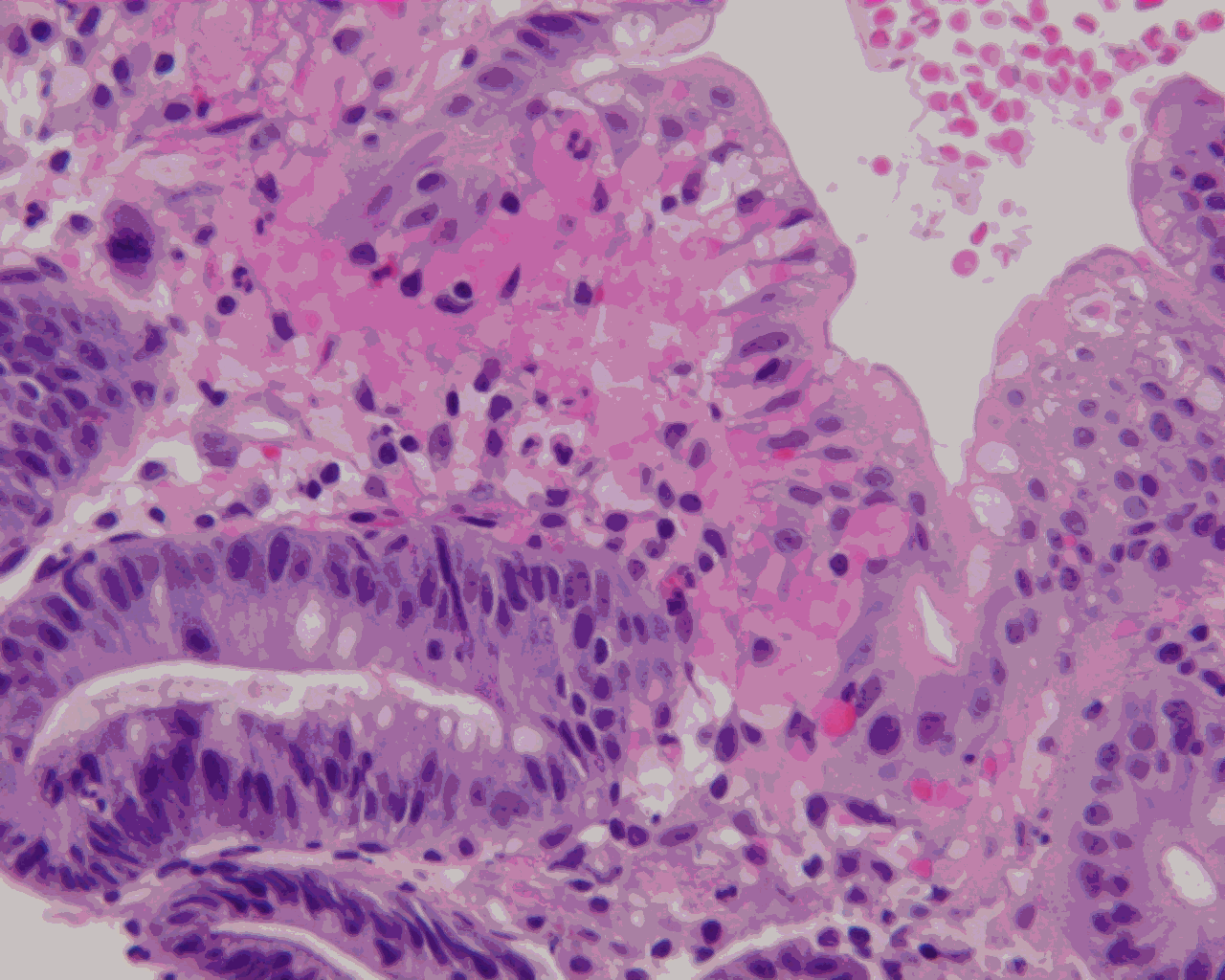 Liga de Patologia - UFC: ISQUEMIA MESENTÉRICA