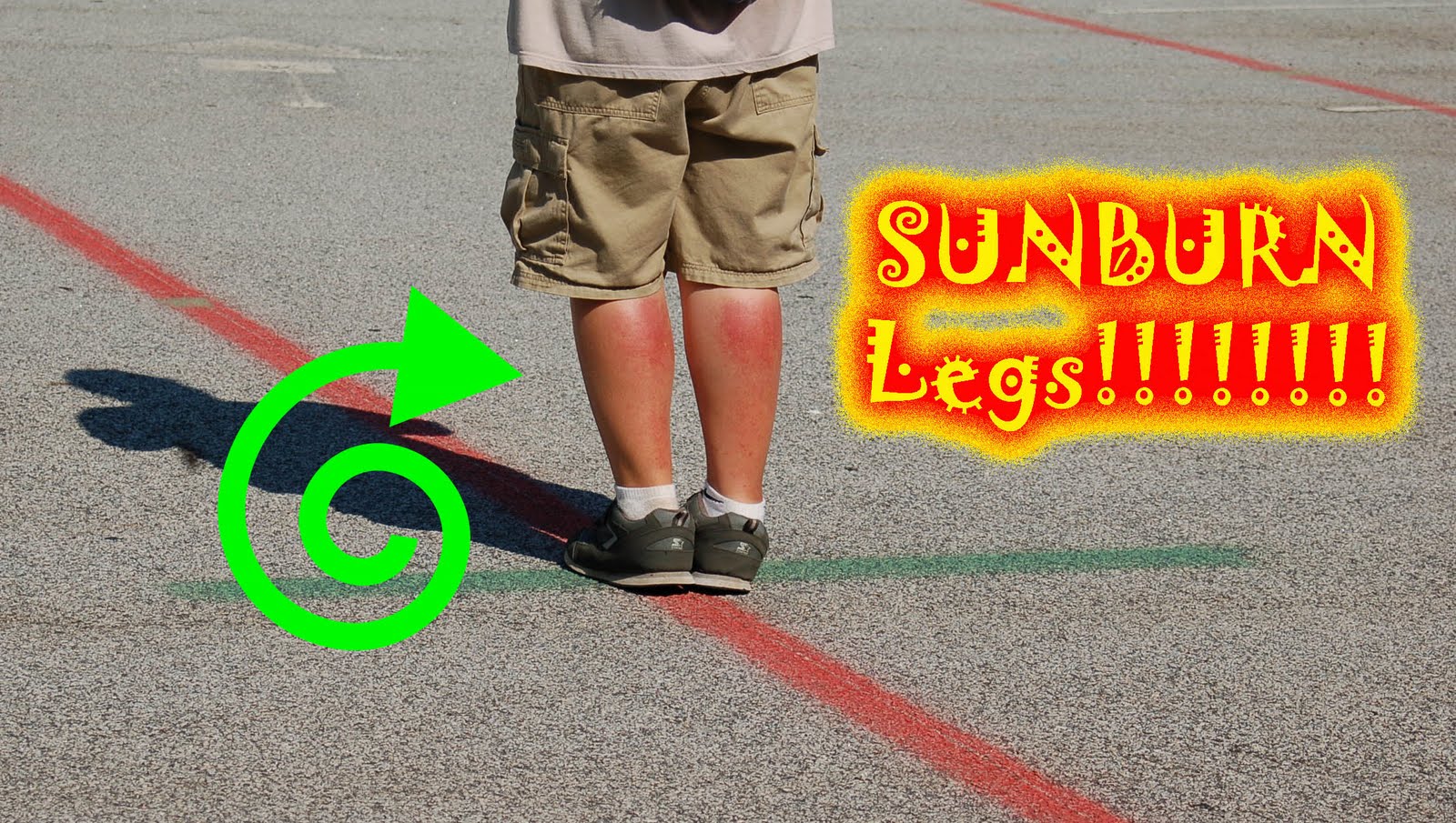 Sunburn Leg Memes
