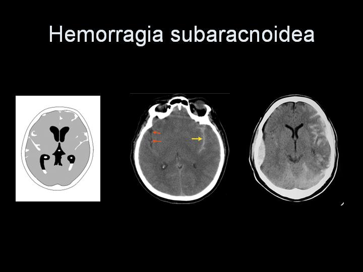 Neuroimagen.com: Hemorragia subaracnoidea