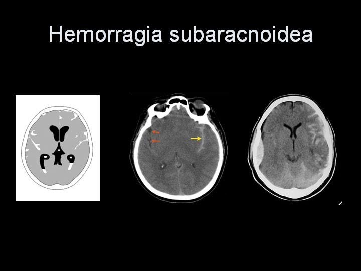 Neuroimagen.com: Hemorragia subaracnoidea