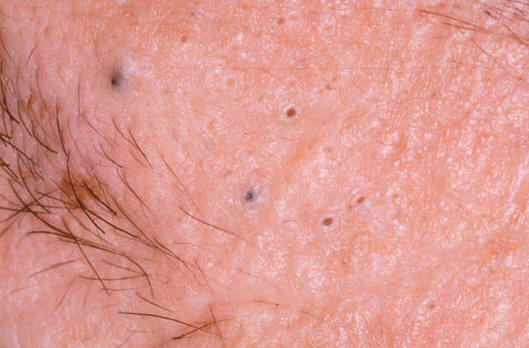 Fair Queens: Exfoliative Dermatitis