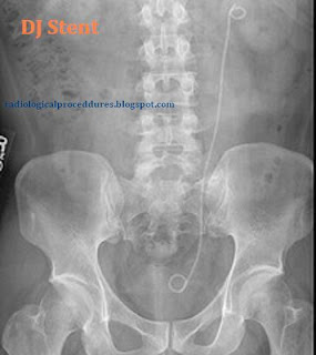 Radiological Procedures: DJ Stenting