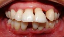 Anibal Ribeiro - Ortodontia: Periodontite ou piorréia