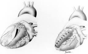 white opti crews: What Is Batista Operation???