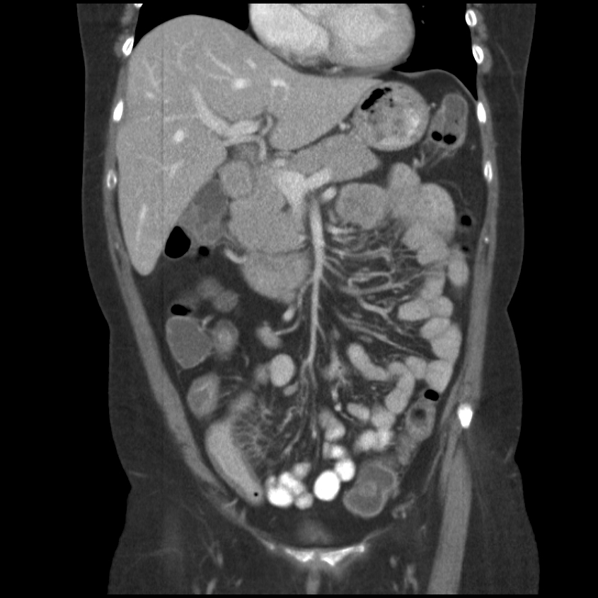 CASOS Y SIGNOS RADIOLÓGICOS: Comb sign - Signo del peine: Enfermedad de ...