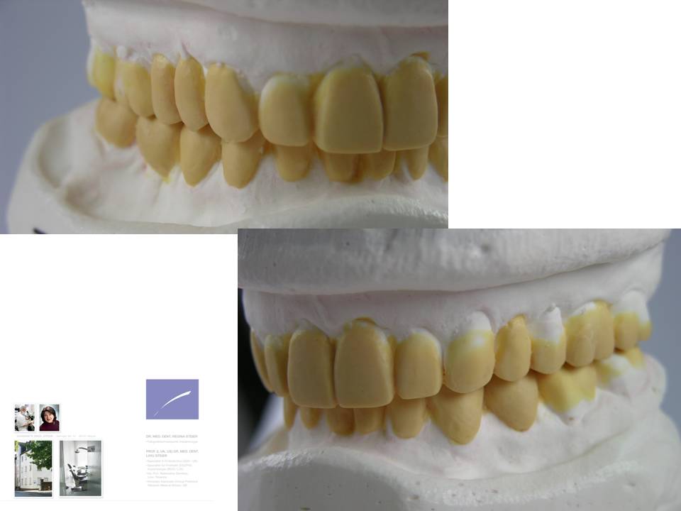 Implantdentistry and related topics: Wax up of study casts for correct ...