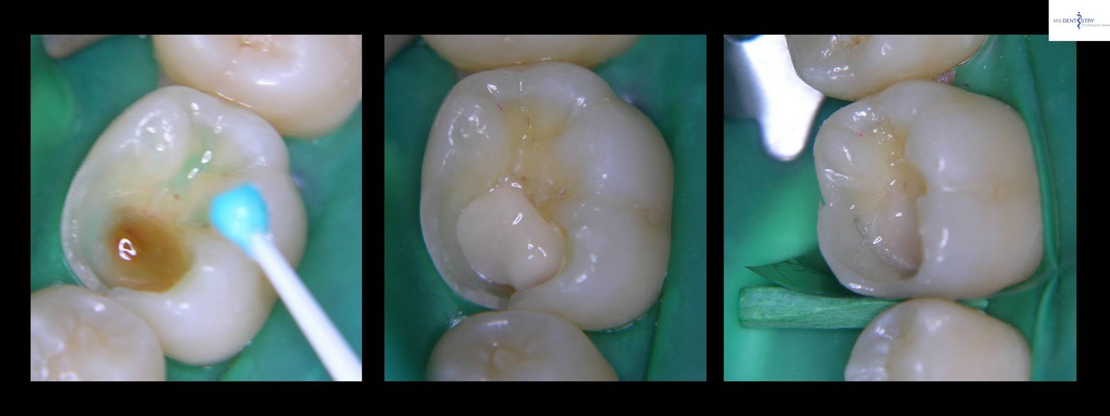 Implantdentistry and related topics: Direct composite restoration