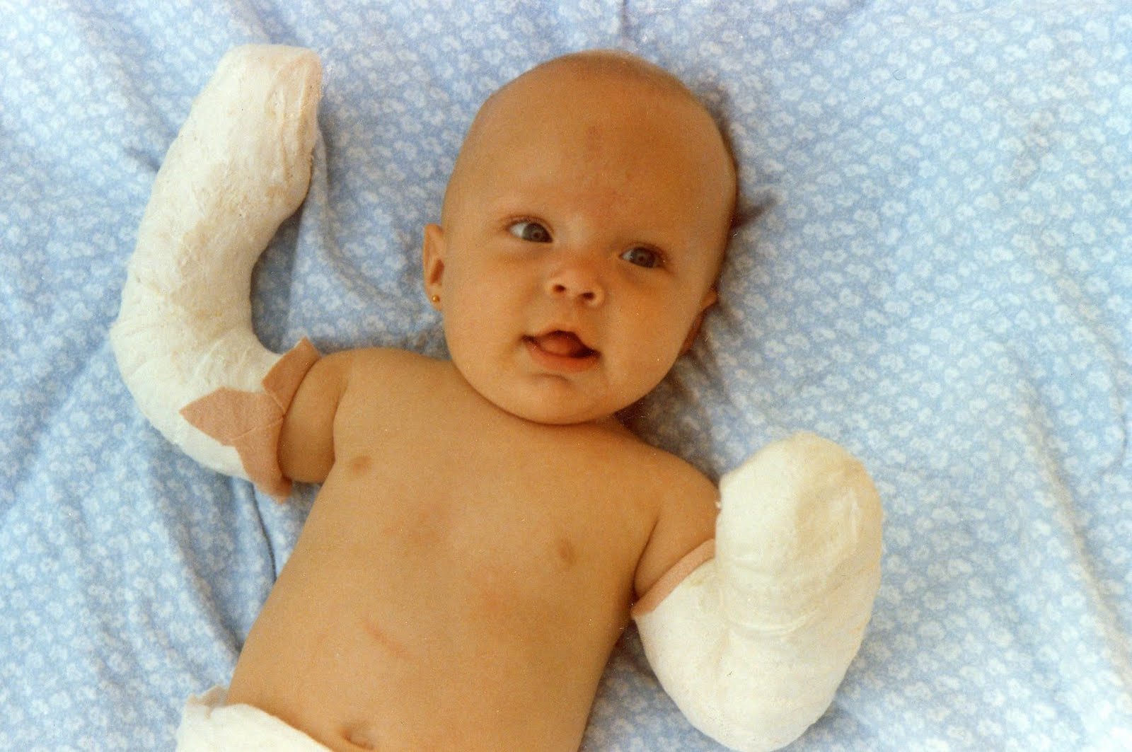 Amniotic Band Syndrome Amniotic Band Syndrome