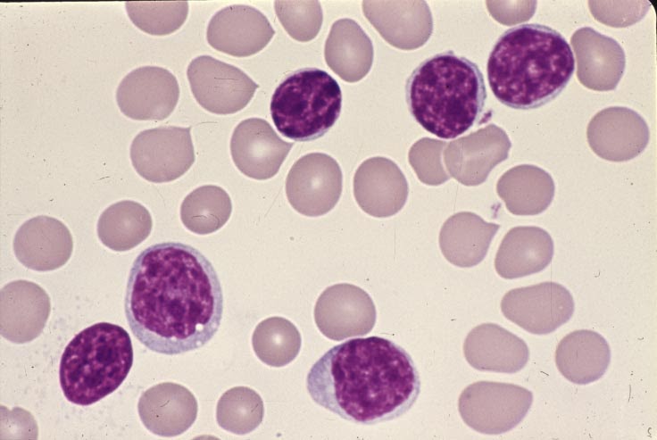 mutations of mortality: CLL differential diagnosis