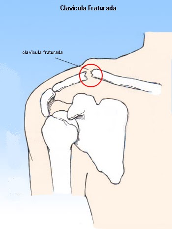 Fisioterapia Passo Fundo: FRATURA DA CLAVÍCULA