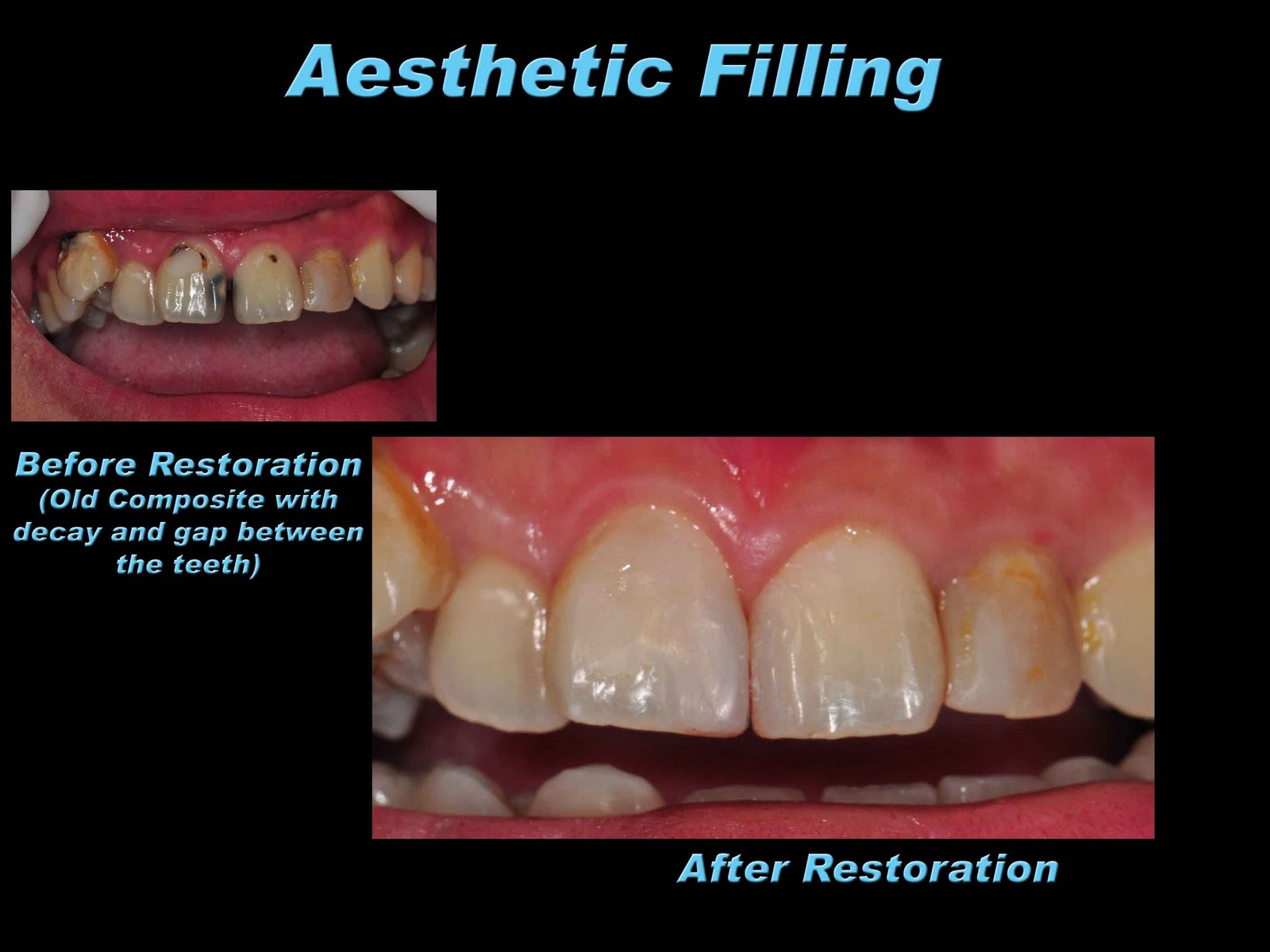 Prestige Dental Care: Aesthetic Filling