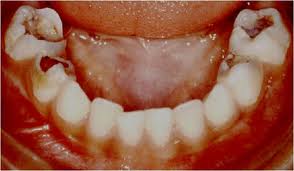 Treatment Options: What is Tooth Decay?