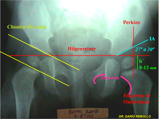 Revisiones_bibliográficas TyO_Web: Deformidades de caderas en niños