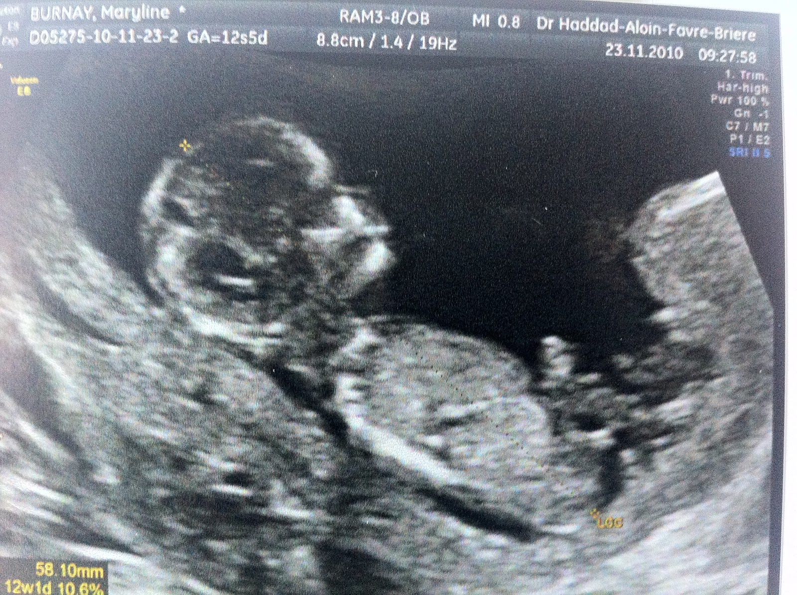 Un petit bout de nous...: Echographie du 1er trimestre. 11 semaines de ...