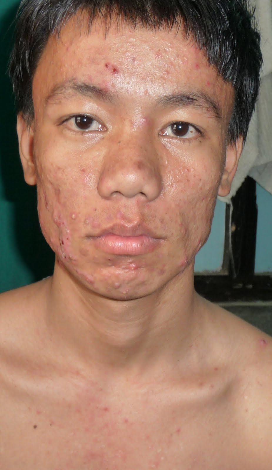 Steroids For Acne Vulgaris at Elaine Osborn blog