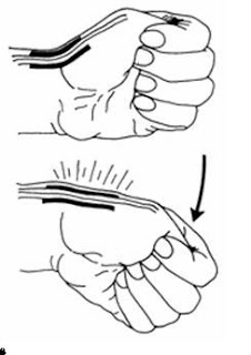 CAREX Sport Medicine: TENOSINOVITIS DE QUERVAIN