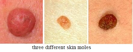 About Wart Removal And Treatment: Facts About Warts That You Should Know