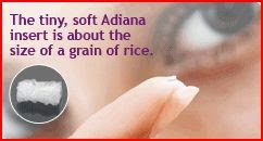 Adiana Permanent Contraception - The Well-Timed Period