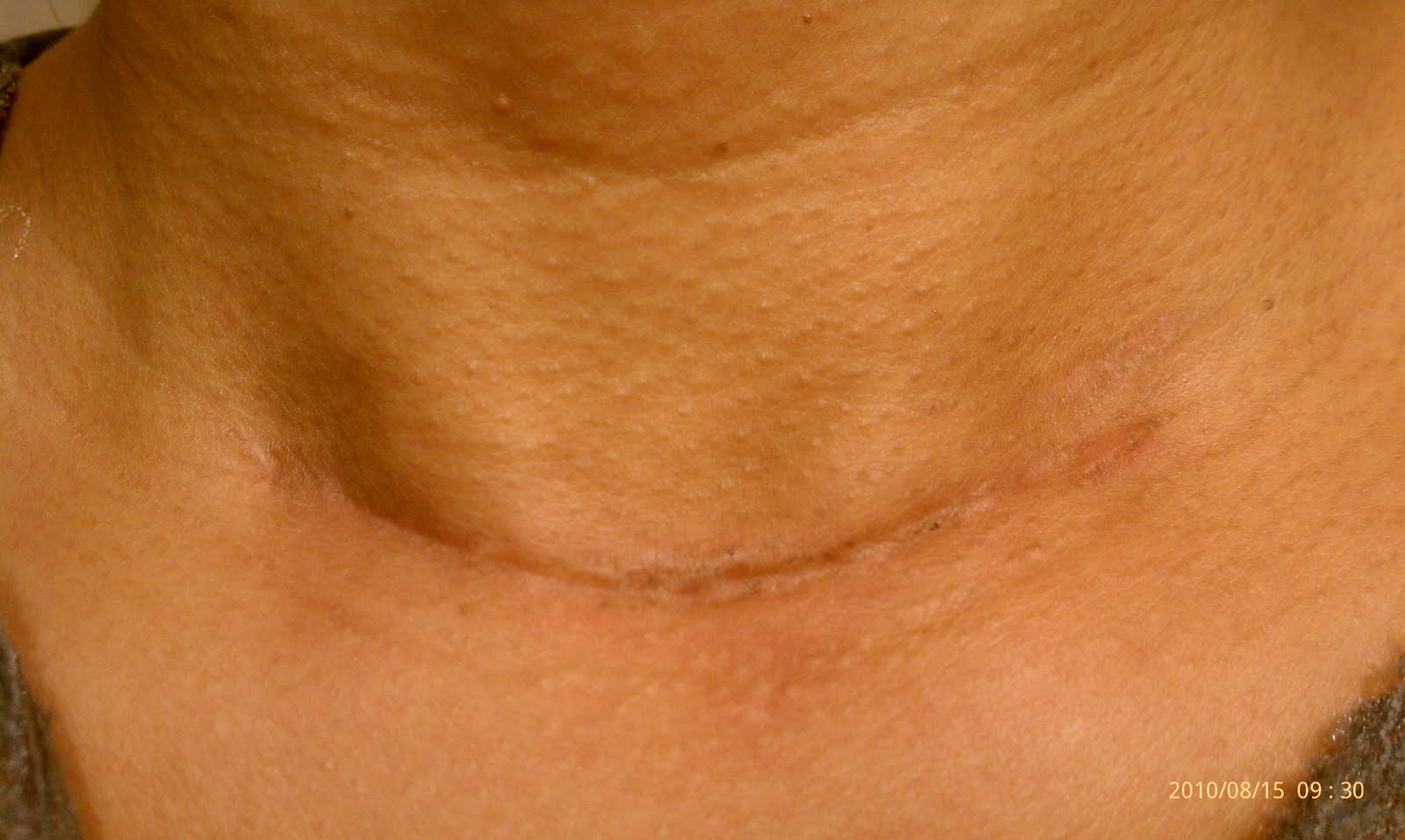 How does my neck look?: August 2010