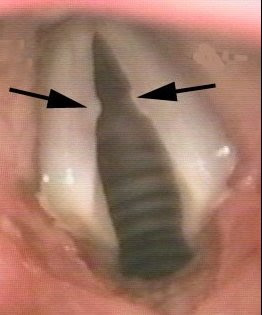 ENT for medical students: LARYNX - Inflammations