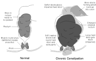 healthy sole healthy Mind and then healthy body: Now Beware of constipation