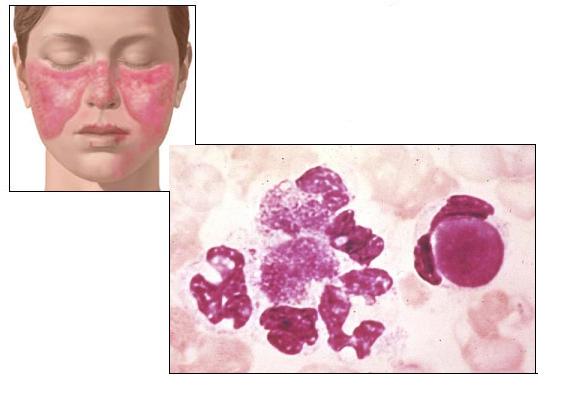 Conceitos Patológicos: Lupus