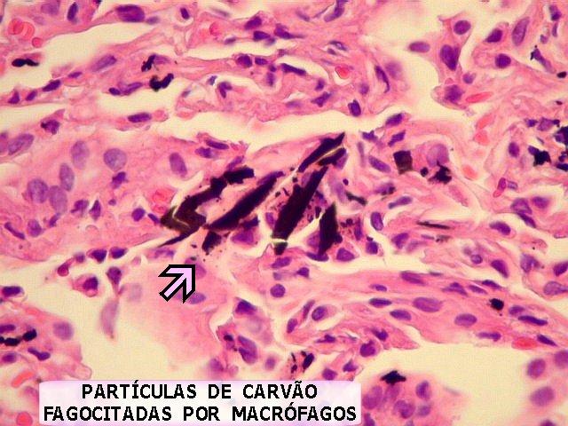 Patologia Urgente: Pneumoconiose ...