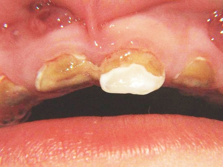 HABLEMOS ENTRE DIENTES: LA CARIES RAMPANTE O ENFERMEDAD DEL BIBERÓN