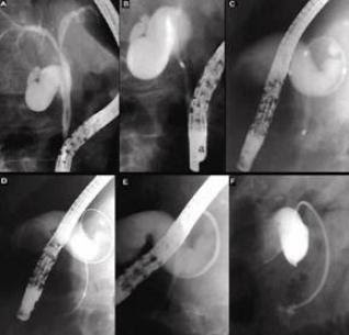 ABCDESPORTO: COLANGIOGRAFIA