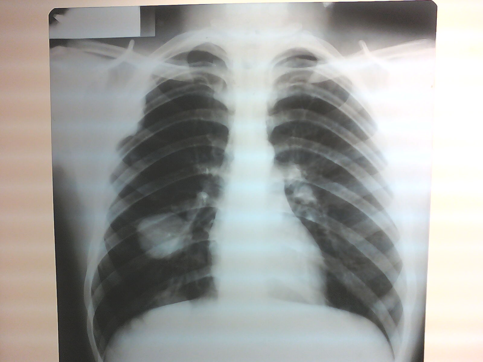 Rx 2010: Torax Postero Anterior