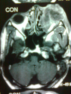 ummara shares: CA SUPRASTRUCTURE OF LEFT MAXILLARY ANTRUM
