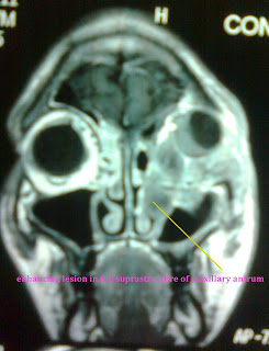 ummara shares: CA SUPRASTRUCTURE OF LEFT MAXILLARY ANTRUM