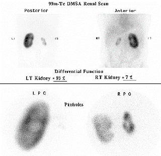 ummara shares: SCARRED RIGHT KIDNEY on DMSA scan