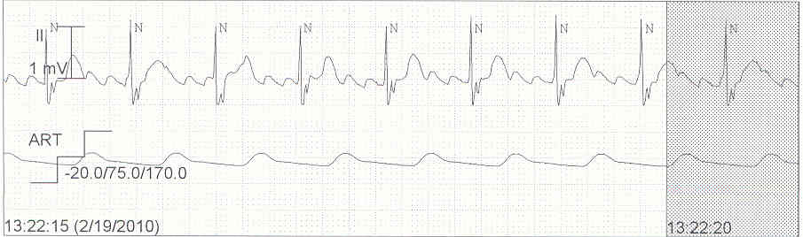 Icd 10 atrial flutter - riskfeti