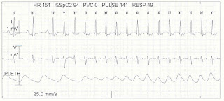 Pedi cardiology: SVT - Onset, Termination - Rentry Mechanism